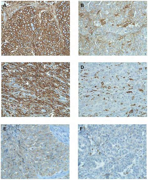 immunohistochemical analysis of high grade serous eoc tumors showing