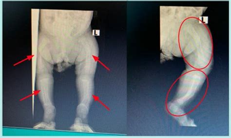 X Ray Lower Extremity Bilateral Ap Lateral View Findings Bowing Os X Ray Lower Extremity Bilateral Ap Lateral View Findings Bowing Os
