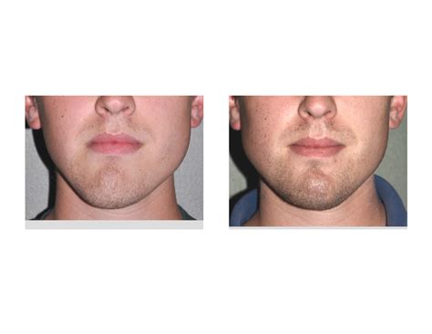 Plastic Surgery Case Study Jaw Asymmetry Correction With Chin Leveling And Jaw Angle Reduction