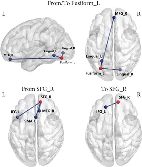 Altered Effective Connectivity Of Left Fusiform And Right Superior