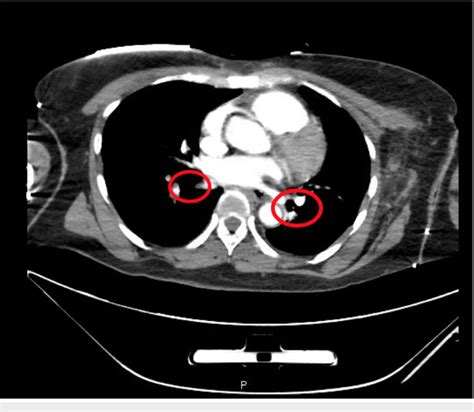 Computed Tomography Angiogram Cta With Contrast Demonstrates Large