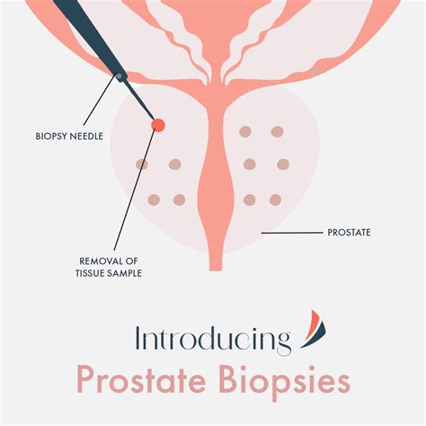 Introducing Prostate Biopsies Mic Radiology Group