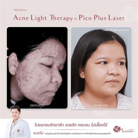 Pico Laser คืออะไร ทำไมถึงยอดนิยม ลดกระ ฝ้า ที่ Blossomclinic