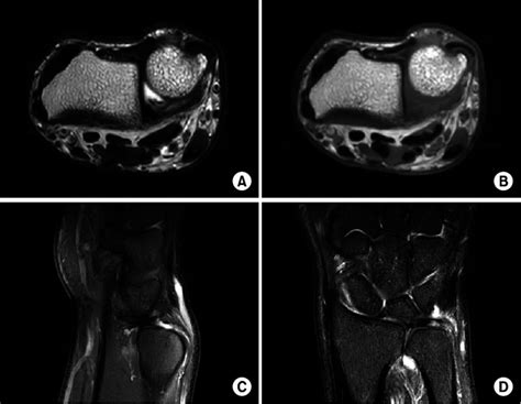 Magnetic Resonance Imaging Findings Of The Triangular Fibrocartilage Download Scientific