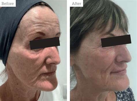 Using A Combination Approach To Ageing R R Aesthetics