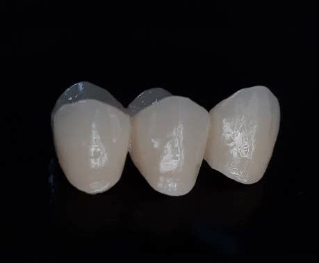 Cirkon Keramička Krunica Dentalni Laboratorij Ivana Rožić Mojkvart Hr
