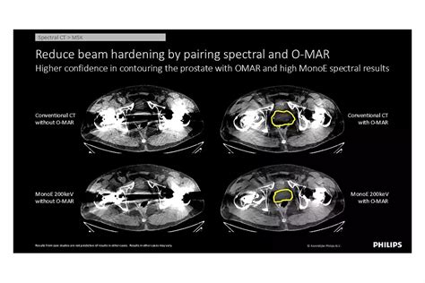 Spectral Ct 7500 Rt Philips