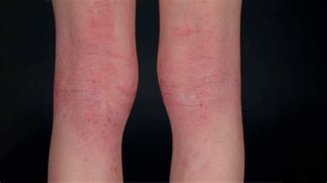 Eczema Behind Knees And On Legs 7 Year Old With Eczema Itchy Rash