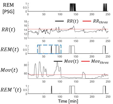 fmcw radar based rem sleep stage detection results a case of normal