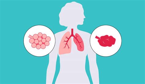 Atelectasis What Is Causes Symptoms Treatment And Prevention