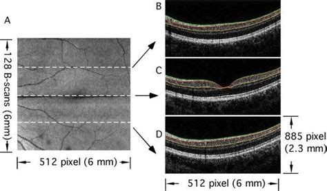 The Oct Macular Cube Scan A Fundus Picture Showing Extent Of Cube Download Scientific Diagram The Oct Macular Cube Scan A Fundus Picture Showing Extent Of Cube Download Scientific Diagram