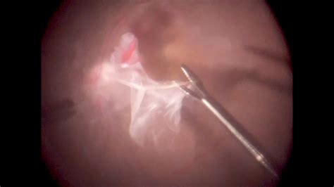 Minimally Invasive Severe Diabetic Retinopathy Vitrectomy With Erm