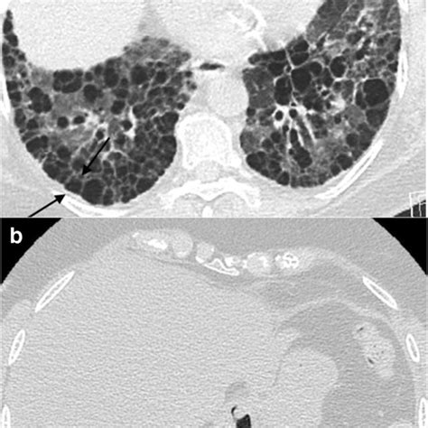 Serial Computed Tomography CT Imaging For Monitoring Disease Download Scientific Diagram