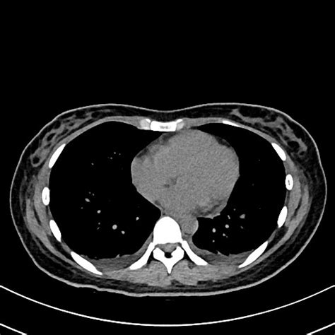 Choledocholithiasis And Choledochal Cyst Radiopaedia 79452 92568 Axial Cholangiogram Nc Commons