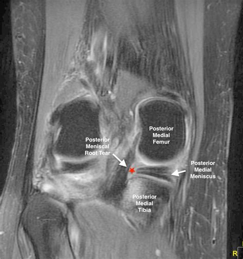 Meniscus Root Tear Surgery Anterior Medial Meniscal Root Cxoz