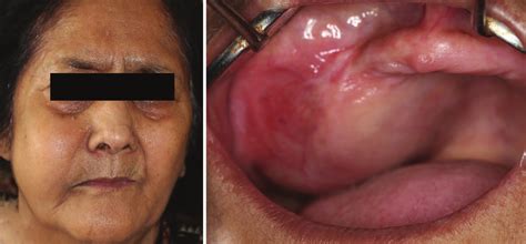 A Extraoral Examination Revealing A Diffuse Swelling On The Right Download Scientific Diagram