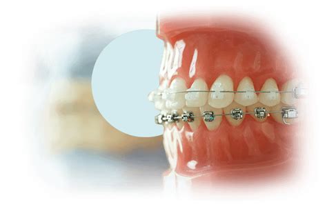 Types Of Braces Darwin Orthodontics