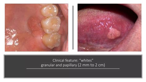 Squamous Papilloma And Verruciform Xanthoma Doctor Faris Alabeedi Msc