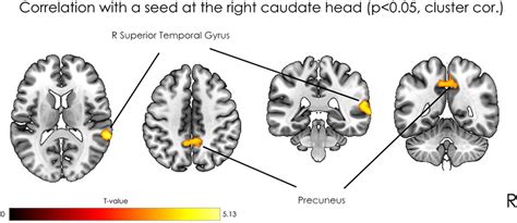 Statistical Parametric Maps Of Seed Based Analysis And Multiple