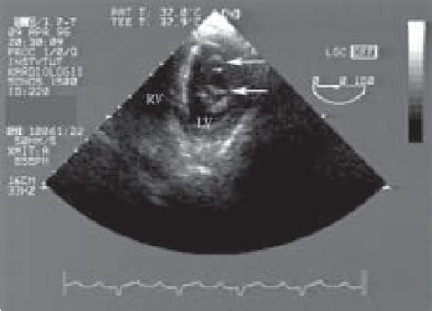 Ostium Primum Atrial Septal Defect Semantic Scholar