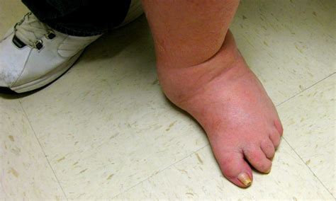 Mengenal Charcot Foot Atau Kaki Charcot Secara Mendalam Rs Medical Hacking Tempat Pengobatan