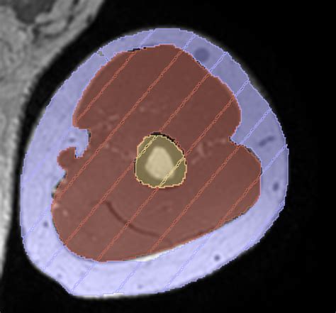 Missing Dots When Drawing Support 3d Slicer Community