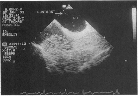 Transoesophageal Echocardiography To E Demonstrating A Patent Fo