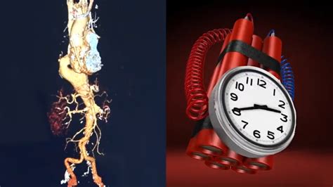 Aortic Aneurysm Warning Signs Silent Killer Ivanhoe Broadcast News Inc