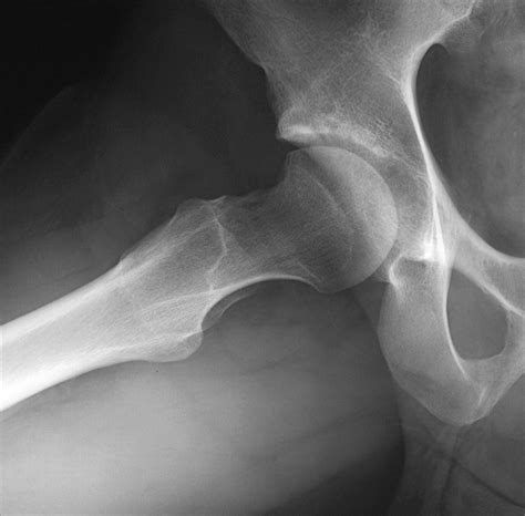 Management Of Arthritis Of The Hip In The Young Adult Bone And Joint