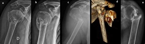 Surgical Neck Sn Fracture A Minimally Displaced Sn Fracture With Download Scientific Diagram