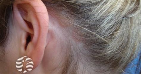 Psoriasis Of The Scalp Image