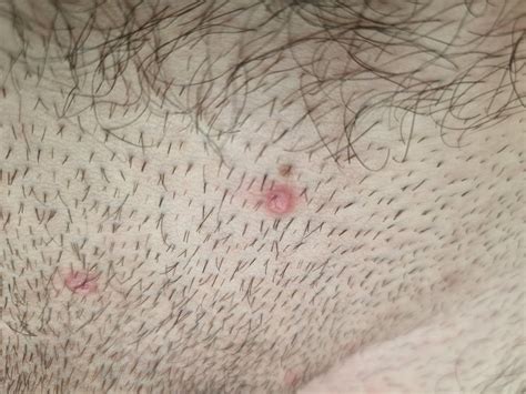 Red Pimples In Genital Area R Dermatologyquestions