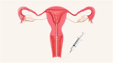 Intrauterine Insemination Iui