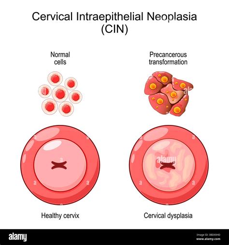 Cancerous Transformation Stock Vector Images Alamy