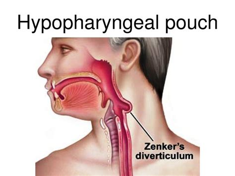 Pharyngeal Pouch Definition Pharyngeal Arches Nvrcq