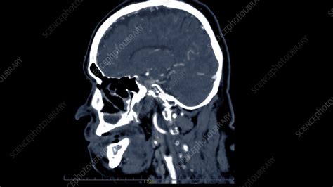 Normal Brain Ct Scan Stock Image F0461045 Science Photo Library