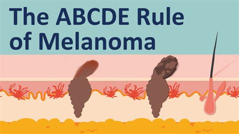 Malignant Melanoma Abcde