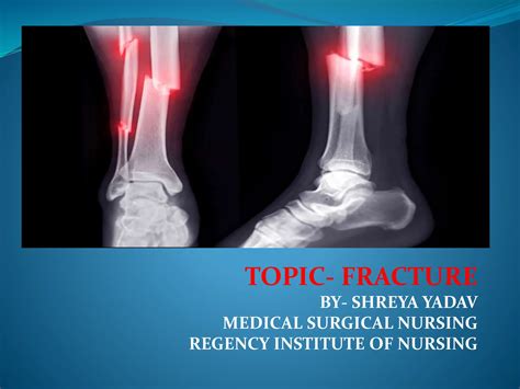 FRACTURE PPT Pptx