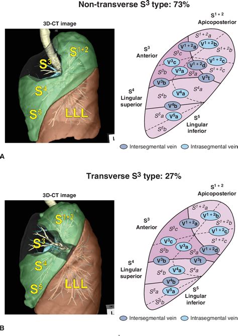 Figure 1 From Segmentectomy Oriented Anatomical Model For Enhanced
