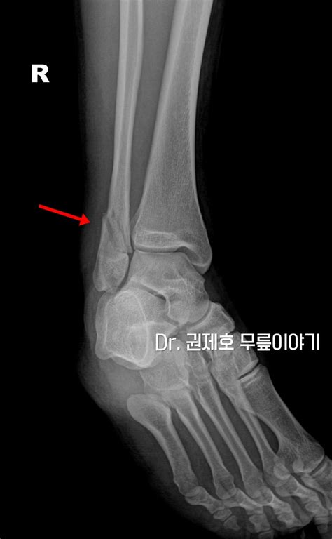 복숭아뼈골절 Malleolar 발목 접질렸을때 간과하지 말자 네이버 블로그