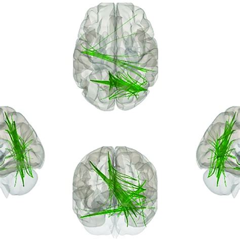 A Comparison In Functional Connectivity Between The Dialogic Reading