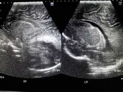 Cochinblogs Is This A Nodular Subcortical Heterotopia Neonatal Brain Ultrasound