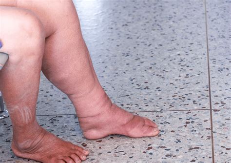 Lymphedema Physical Therapy Treatment — Flora Physical Therapy