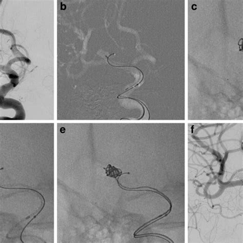 A Unruptured Aneurysm Of Middle Cerebral Artery Proximal Segment M1 Download Scientific