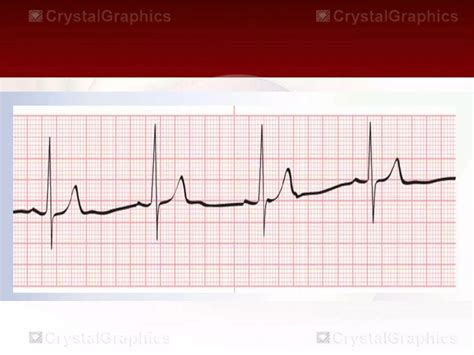 Basic Dysrhythmia Interpretation Pptx