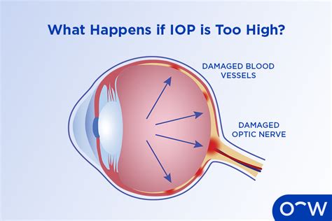 Tonometry Test Importance Procedure Types And Results