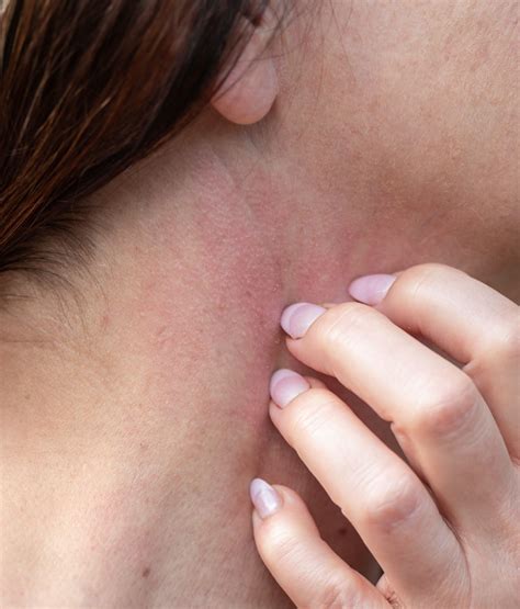 Poikiloderma Treatments New Jersey Tki