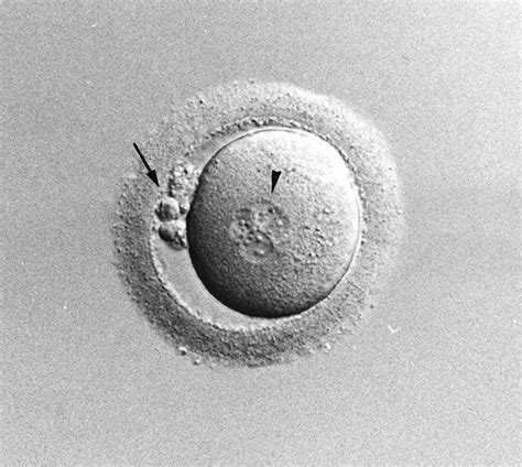 An Oocyte Obtained From Patient Number 6 Assessed For Fertilization At