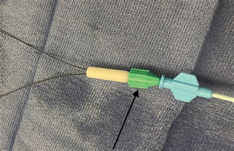 Loop Tip Technique For Replacing Dislodged Catheters American Journal