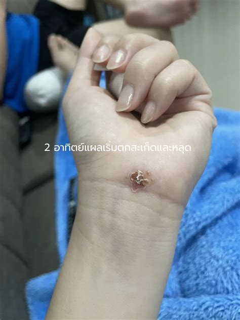 แชร์ประสบการณ์เป็นงูสวัด ตอนอายุ24 😰 แกลเลอรีที่โพสต์โดย Mk ꪔ̤̫ Lemon8